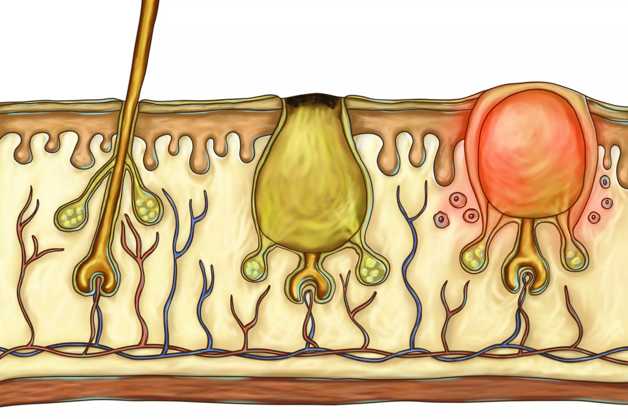 minh họa về mụn dưới da