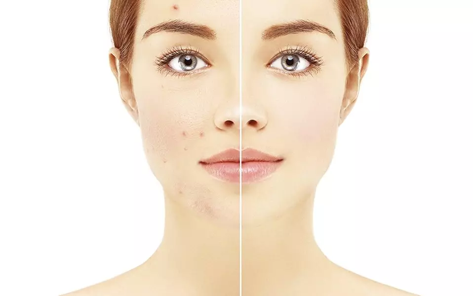 Lavado de cara y cuerpo para el tratamiento del acné
