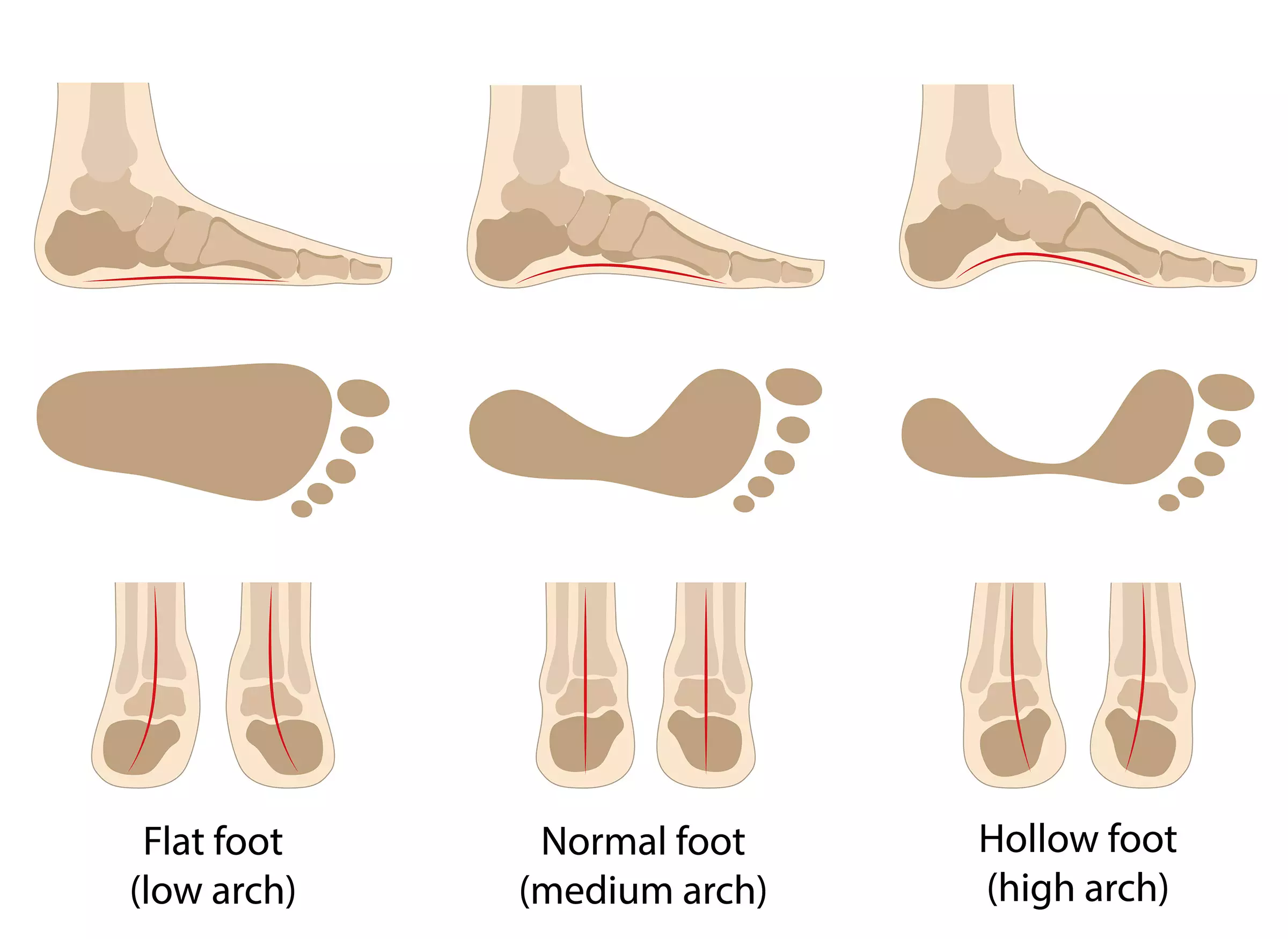 illustratsioon, mis näitab madalate, normaalsete ja kõrgete kaarega jalad