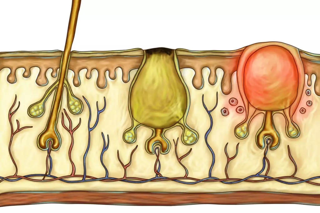 ilustração de acne sob a pele