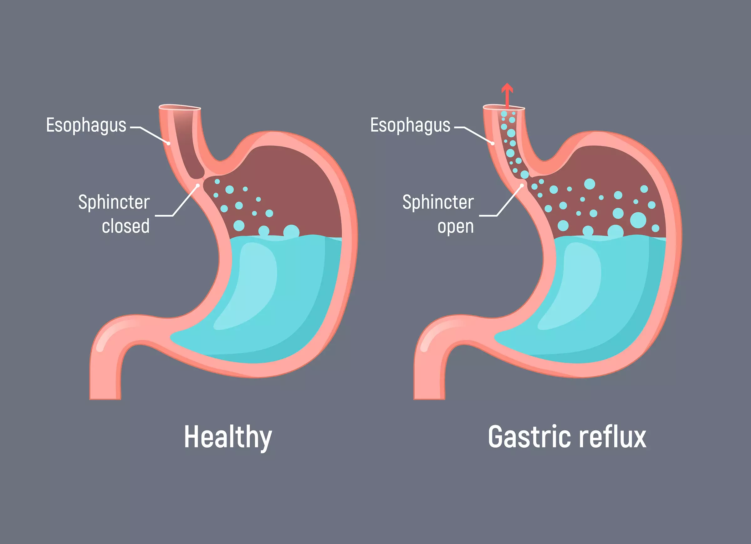 ilustración de acidez estomacal antes y después