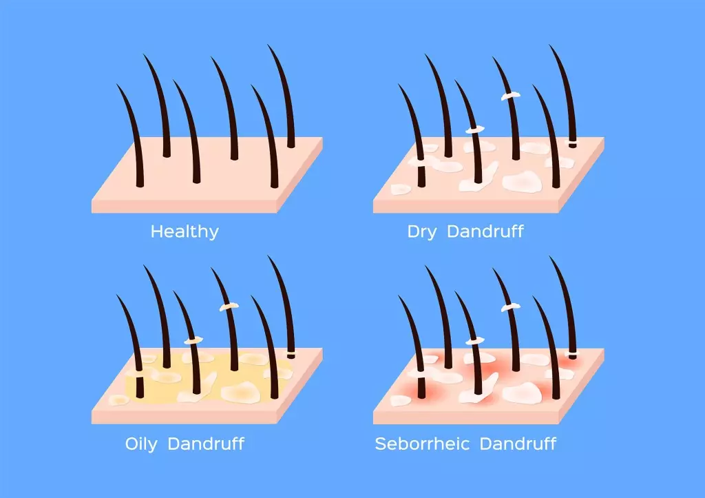 illustrazione di tipi comuni di forfora