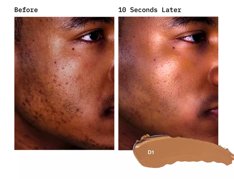 acne líder abans i després
